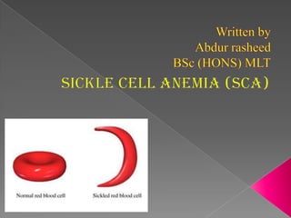 Sickle Cell Anemia | PPTX