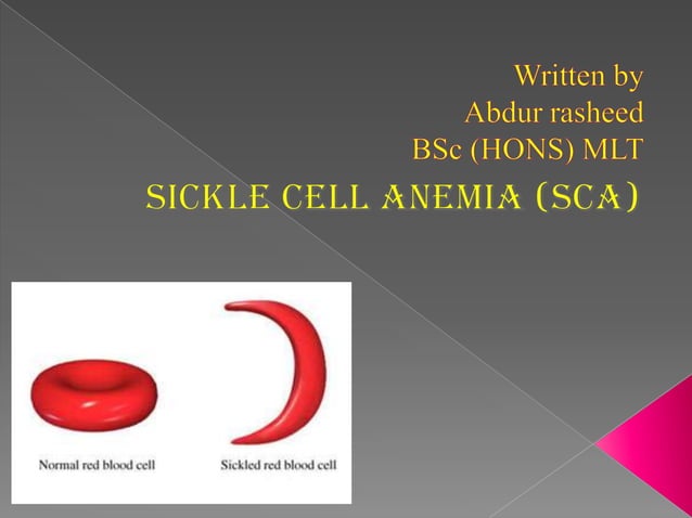 Sickle Cell Anemia | PPT