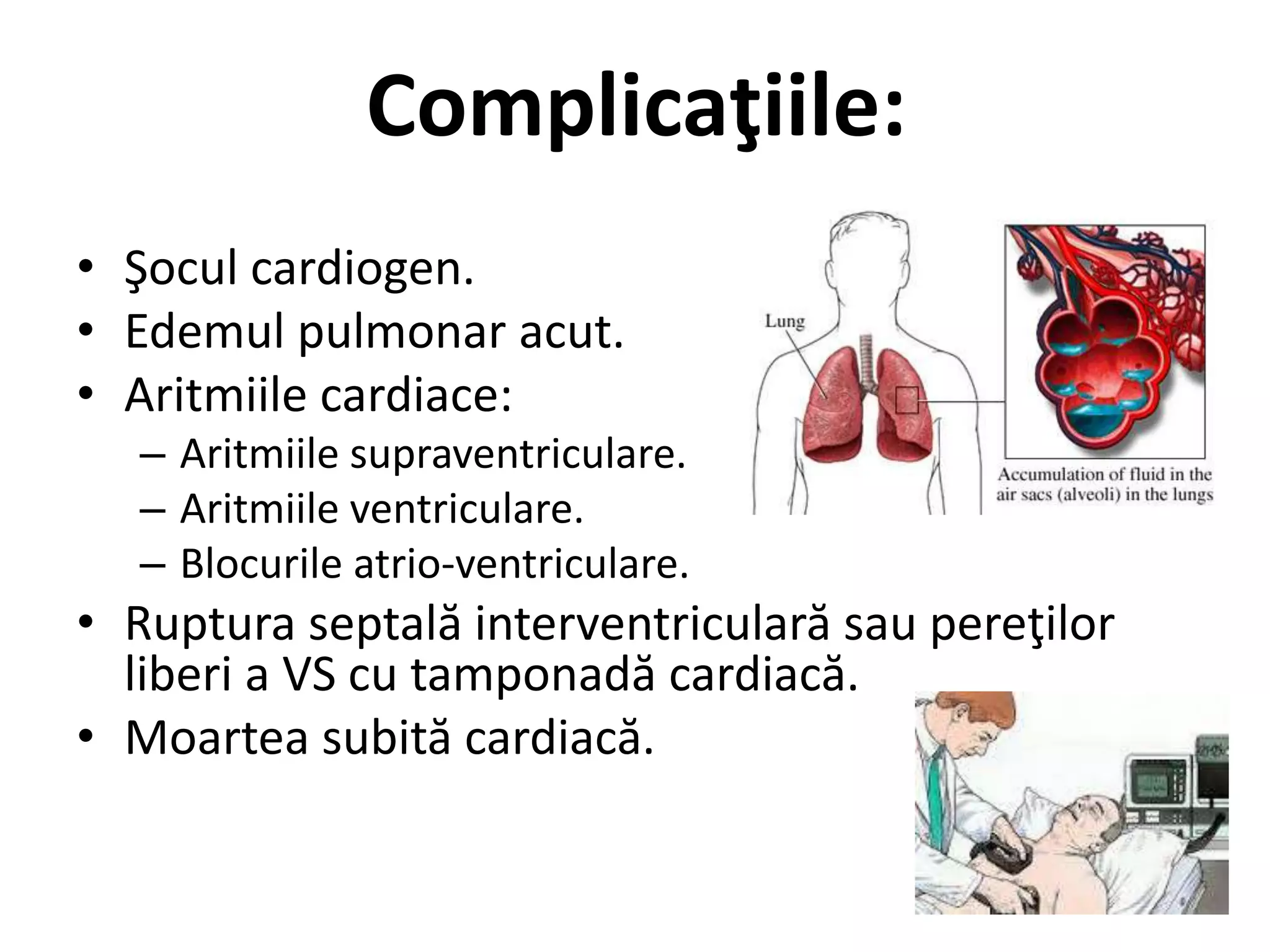 Sindrom Coronarian Acut | PPTX