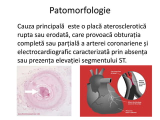 Sindrom Coronarian Acut | PPTX
