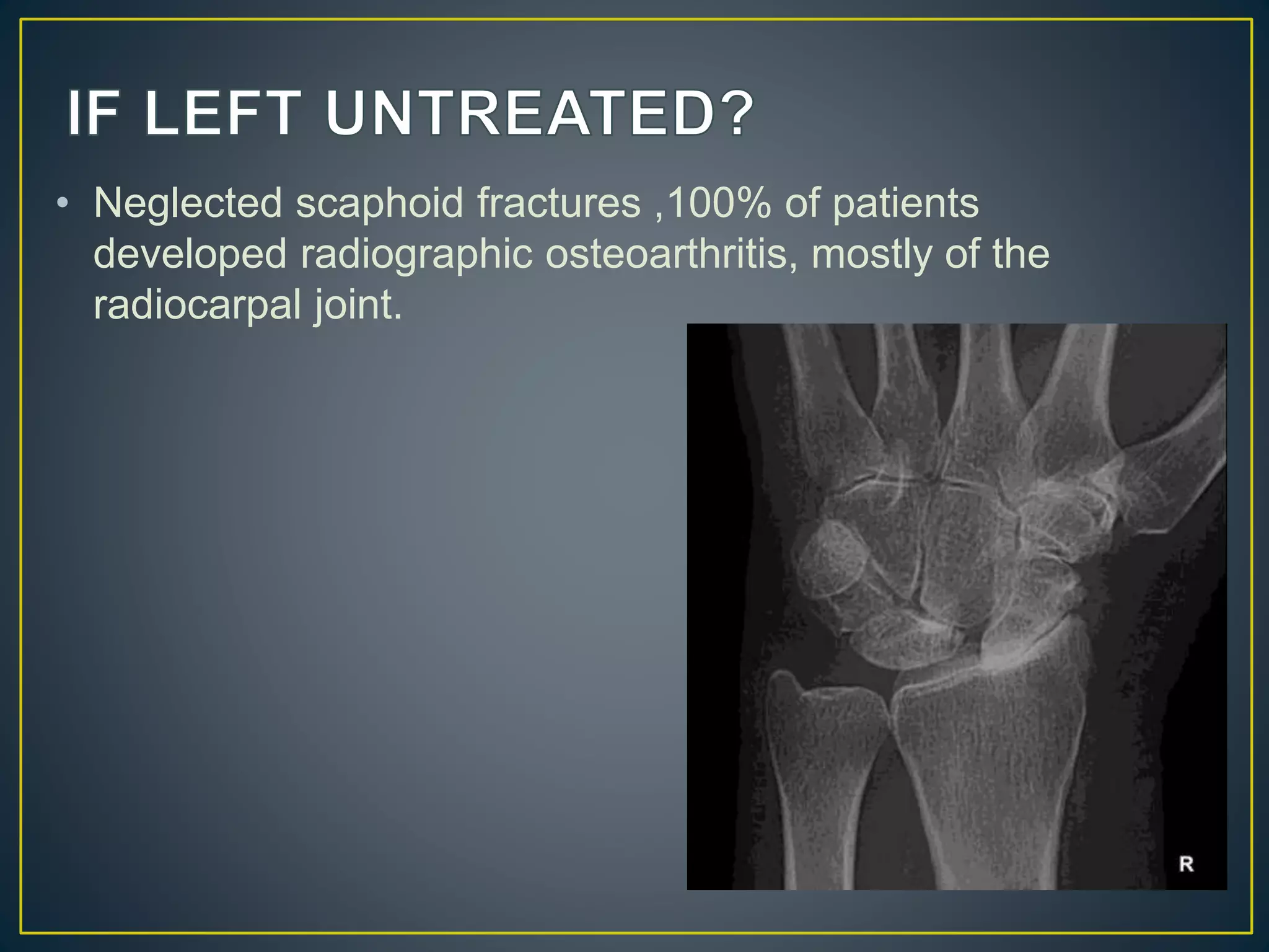 ScaPHOID # | PPT