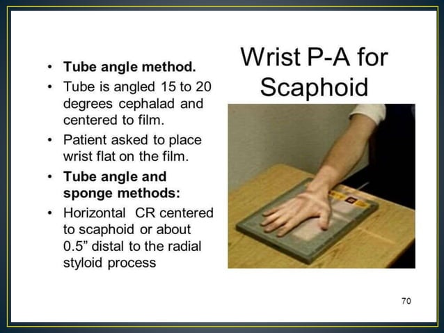 ScaPHOID # | PPT