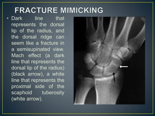 ScaPHOID # | PPT