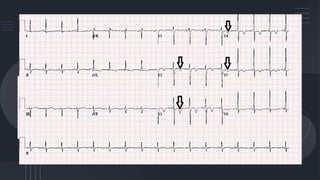 sindrome coronario agudo en IAM con elevacion del st | PPTX