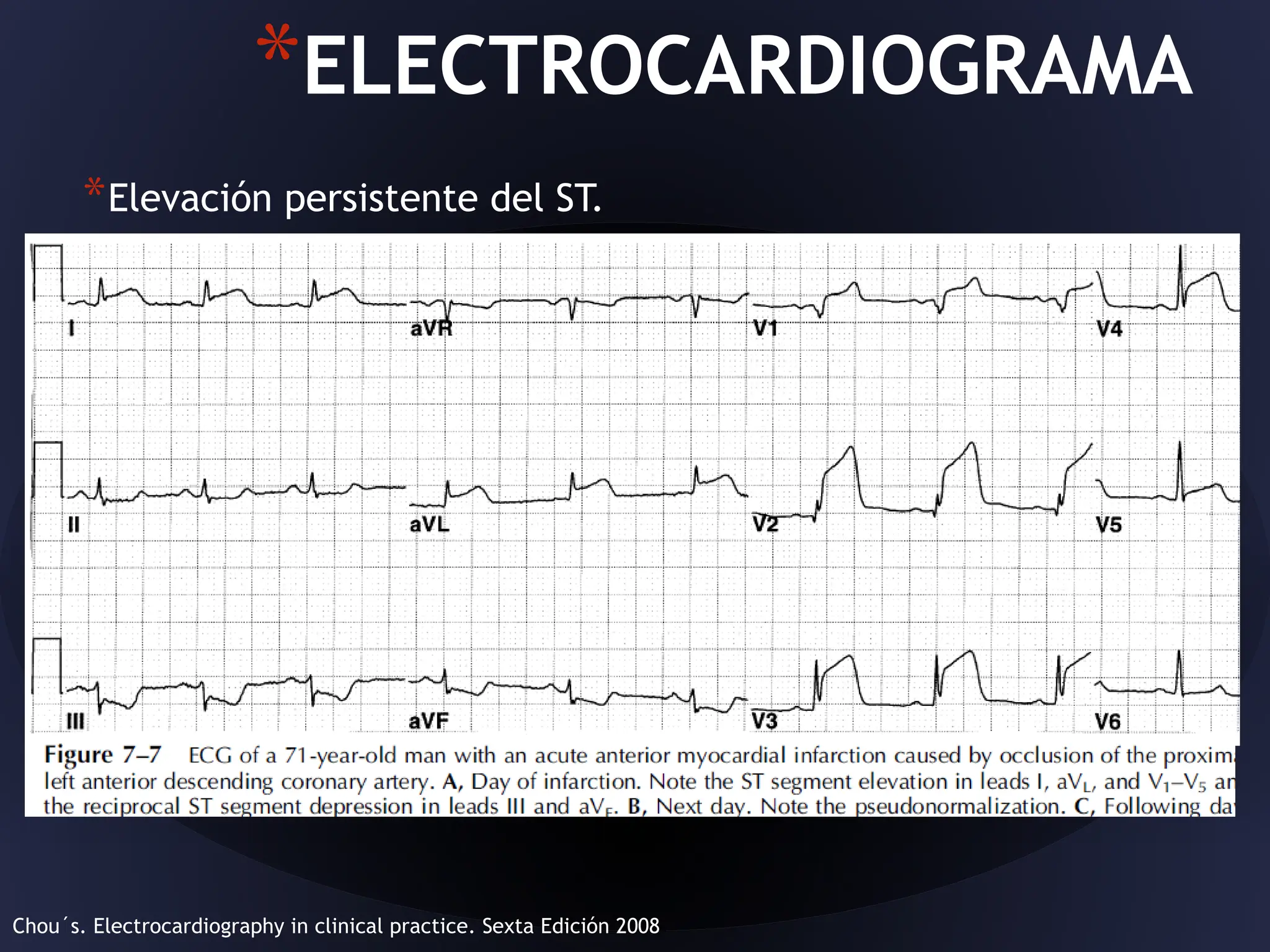 SCA.pptx síndrome Coronario Agudo infarto | PPTX