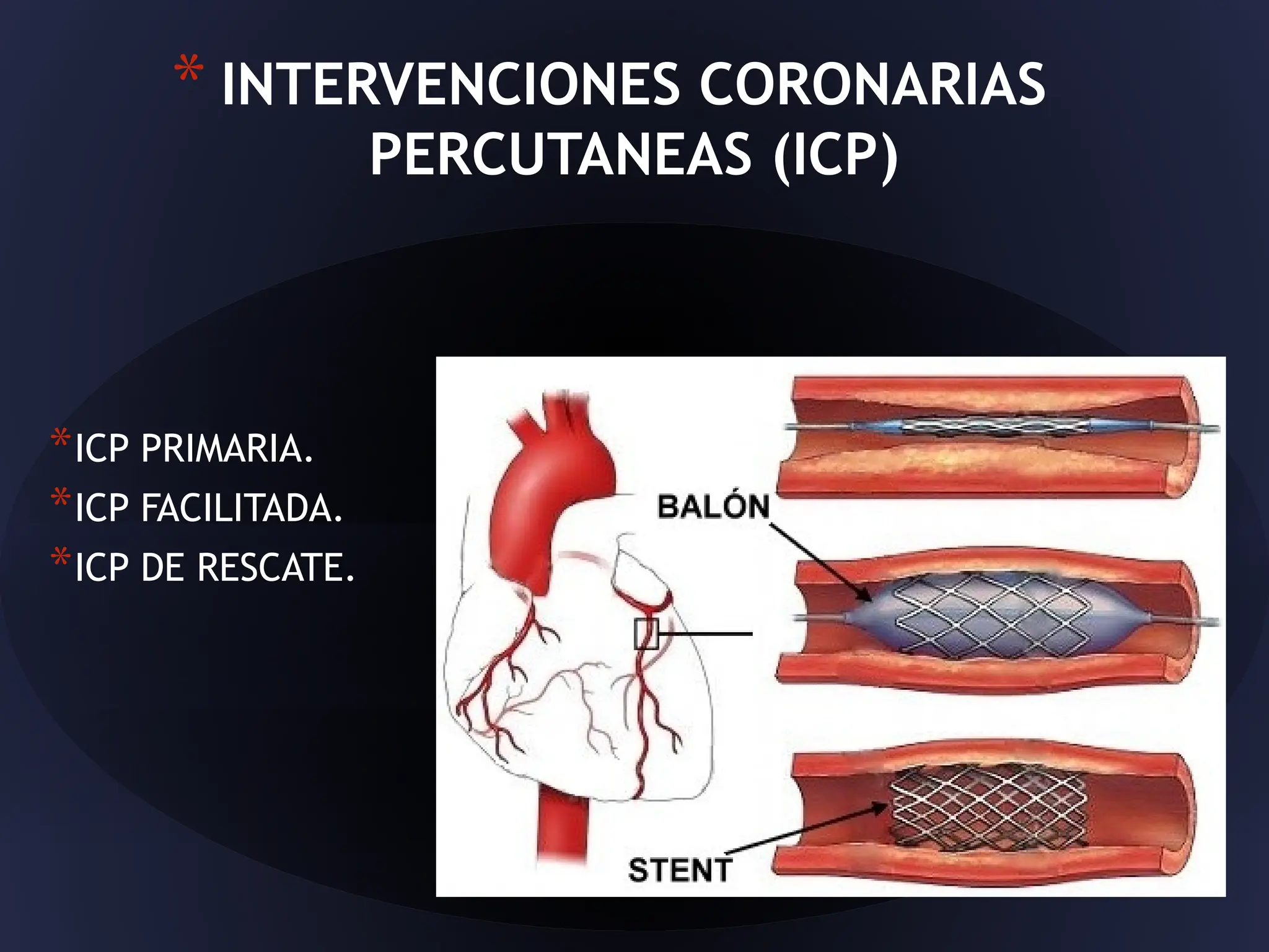 SCA.pptx síndrome Coronario Agudo infarto | PPTX