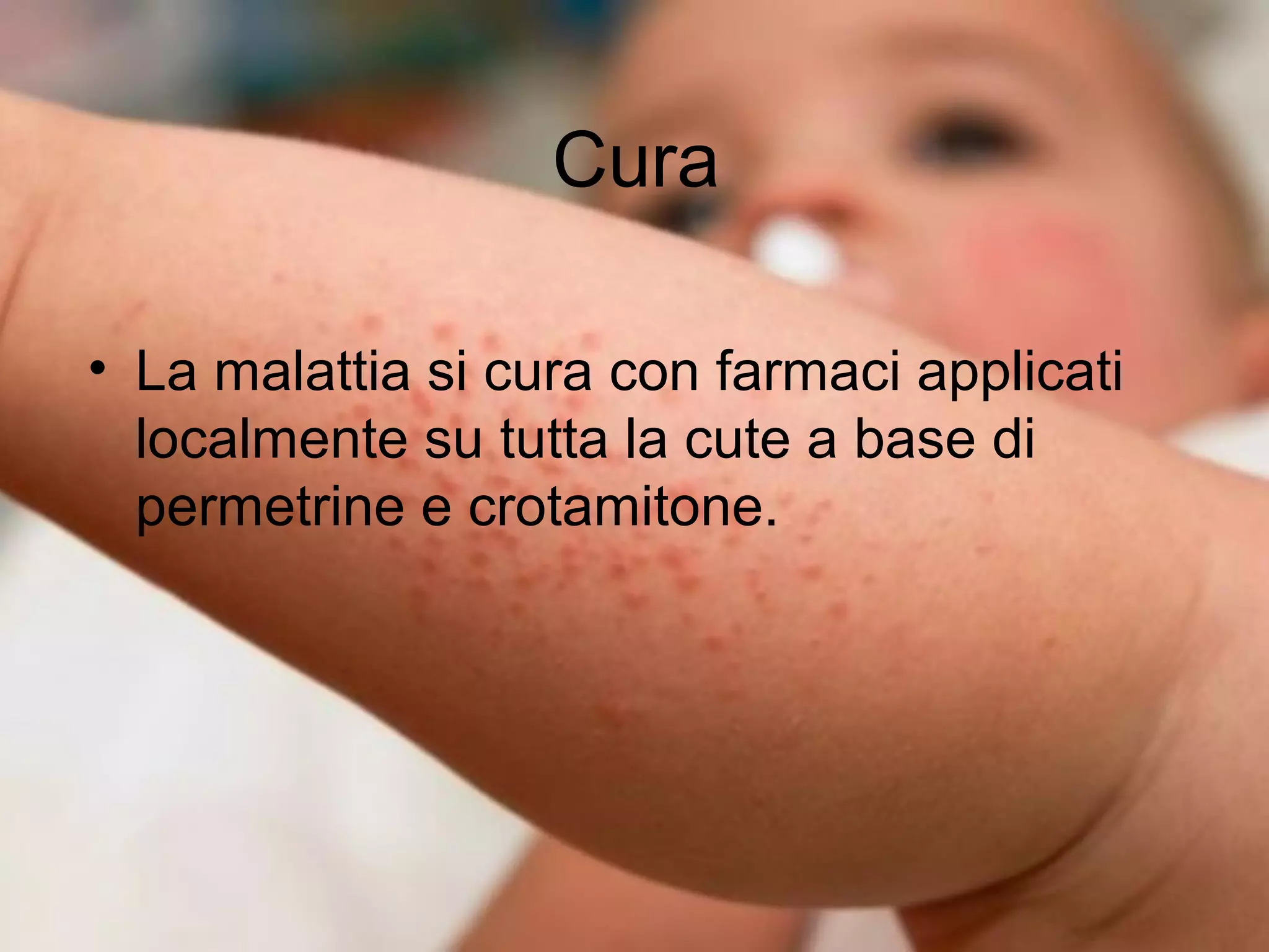 Scabbia e hpv valeria fontanella | PPT