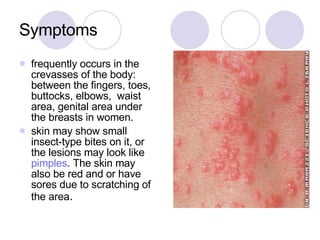 Scabies | PPT | Skin and Dermatology | Diseases and Conditions
