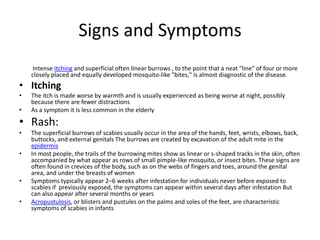 Scabies | PPTX