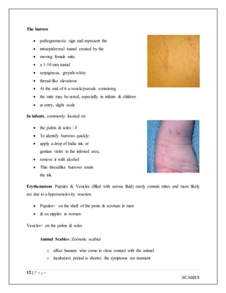 Scabies | PDF