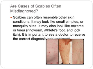 Scabies | PPTX