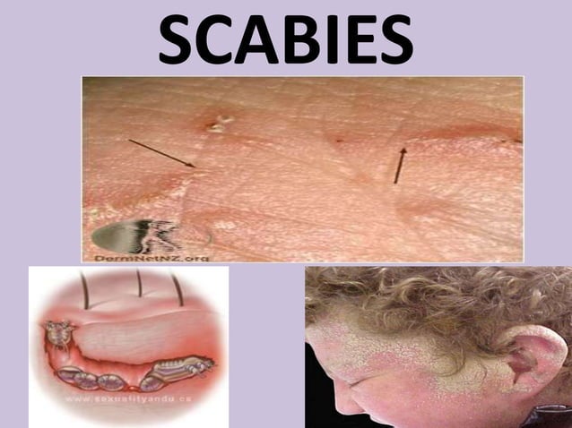 Scabies | PPTX | Allergies | Diseases and Conditions