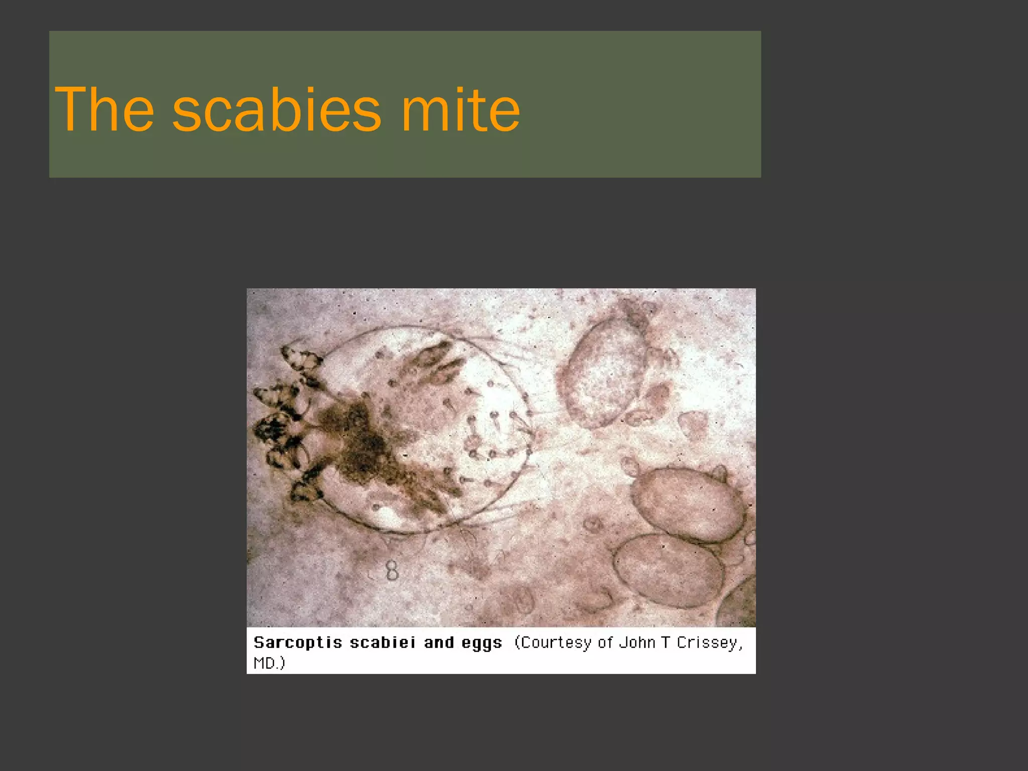 Scabies | PPT