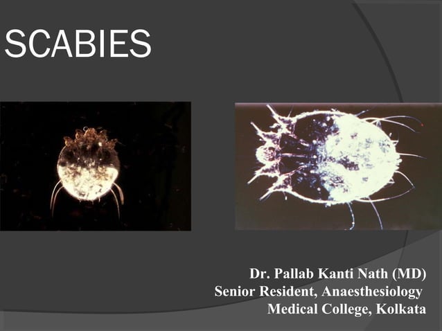 Scabies | PPT | Infectious Diseases | Diseases and Conditions