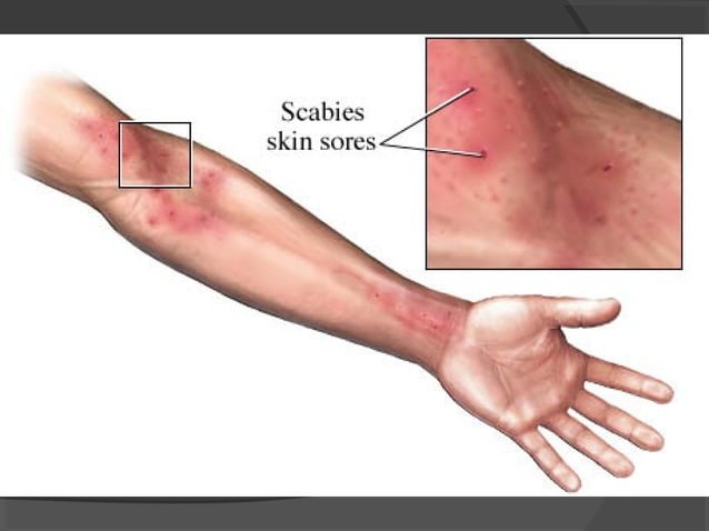 Scabies | PPT | Infectious Diseases | Diseases and Conditions