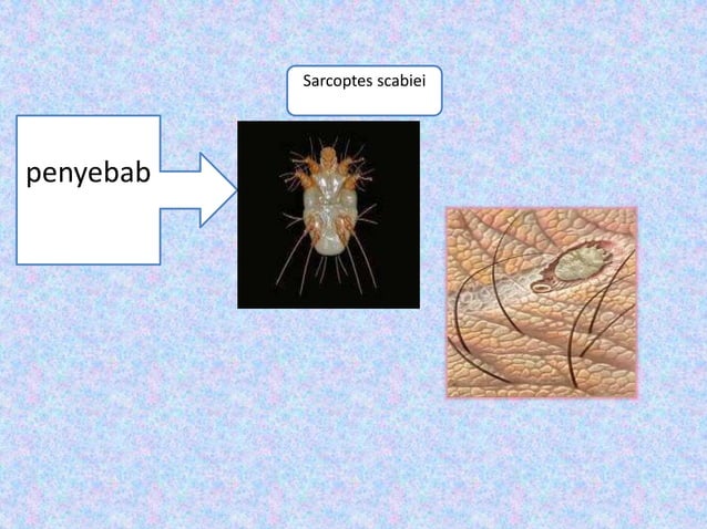 Scabies | PPT