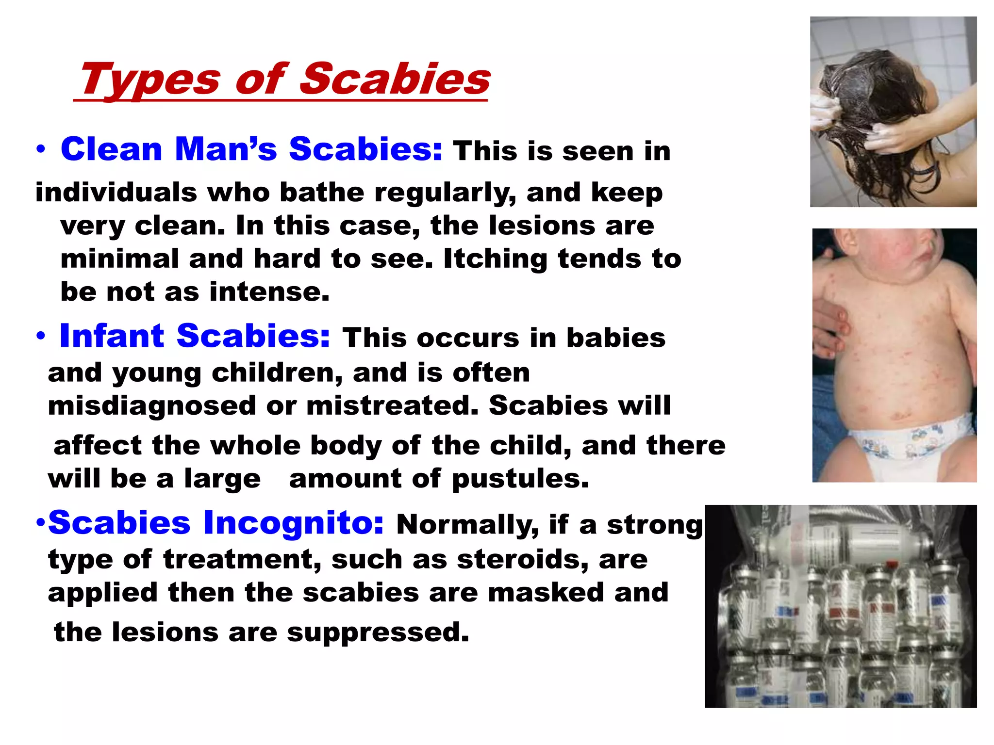 Scabies | PPTX