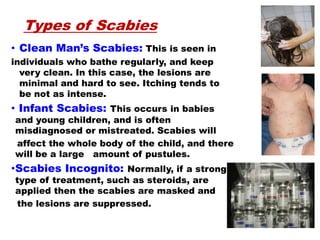 Scabies | PPTX