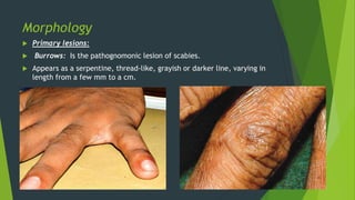 Scabies and pediculosis | PPTX