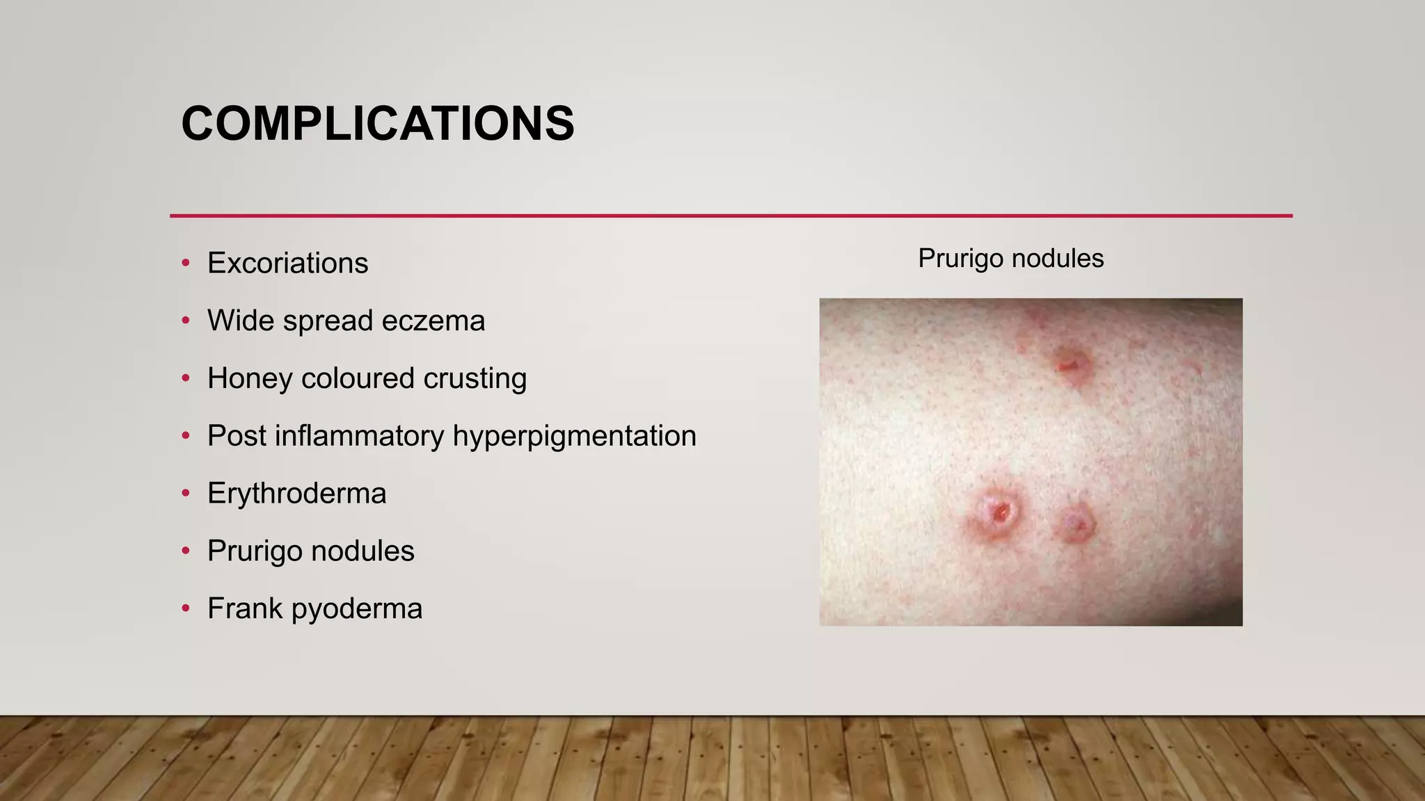 Scabies | PPTX