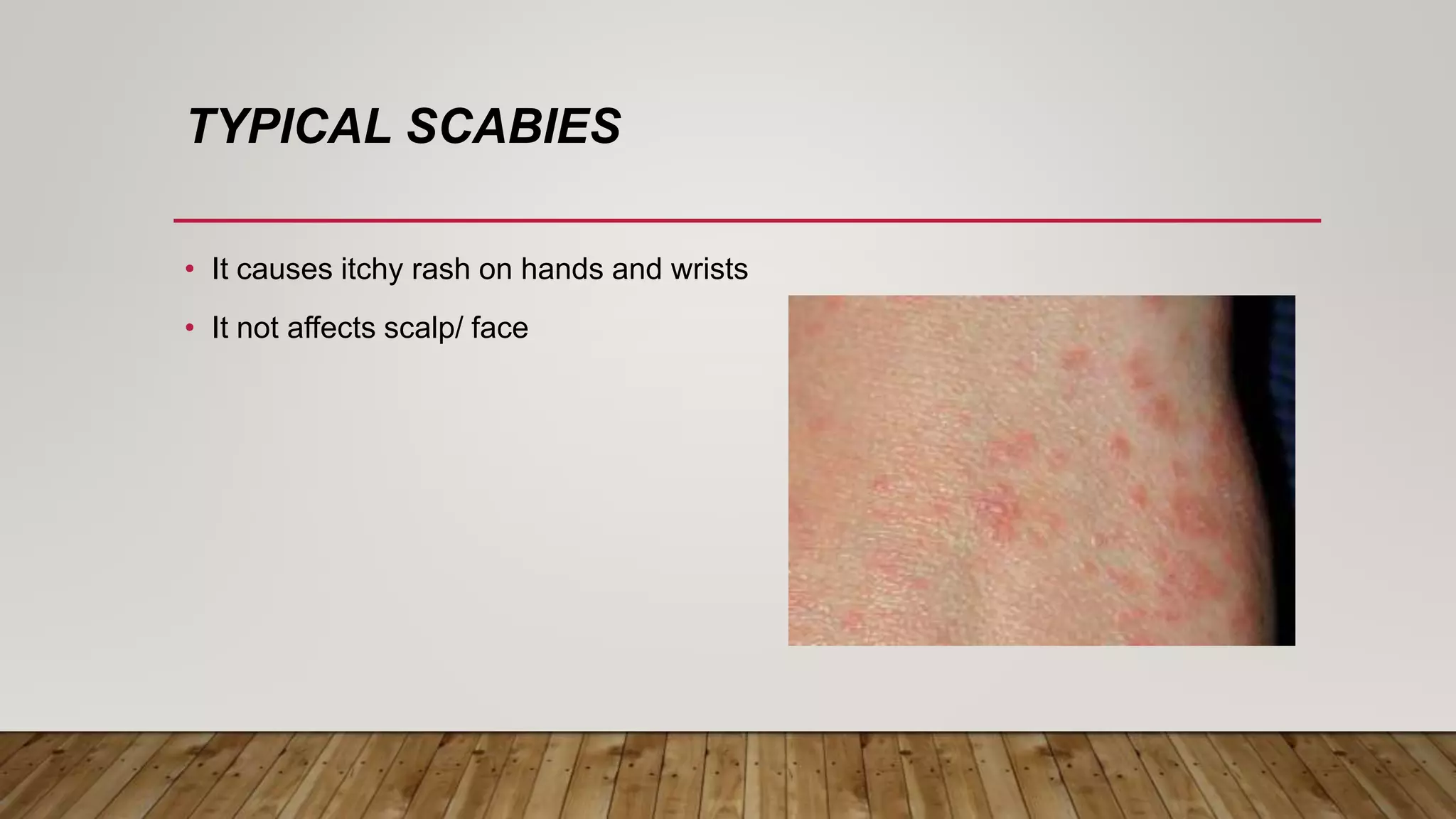 Scabies | PPTX