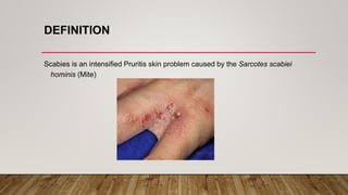 Scabies | PPTX
