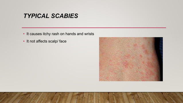 Scabies | PPTX | Skin and Dermatology | Diseases and Conditions
