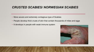 Scabies | PPTX