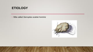 Scabies | PPTX