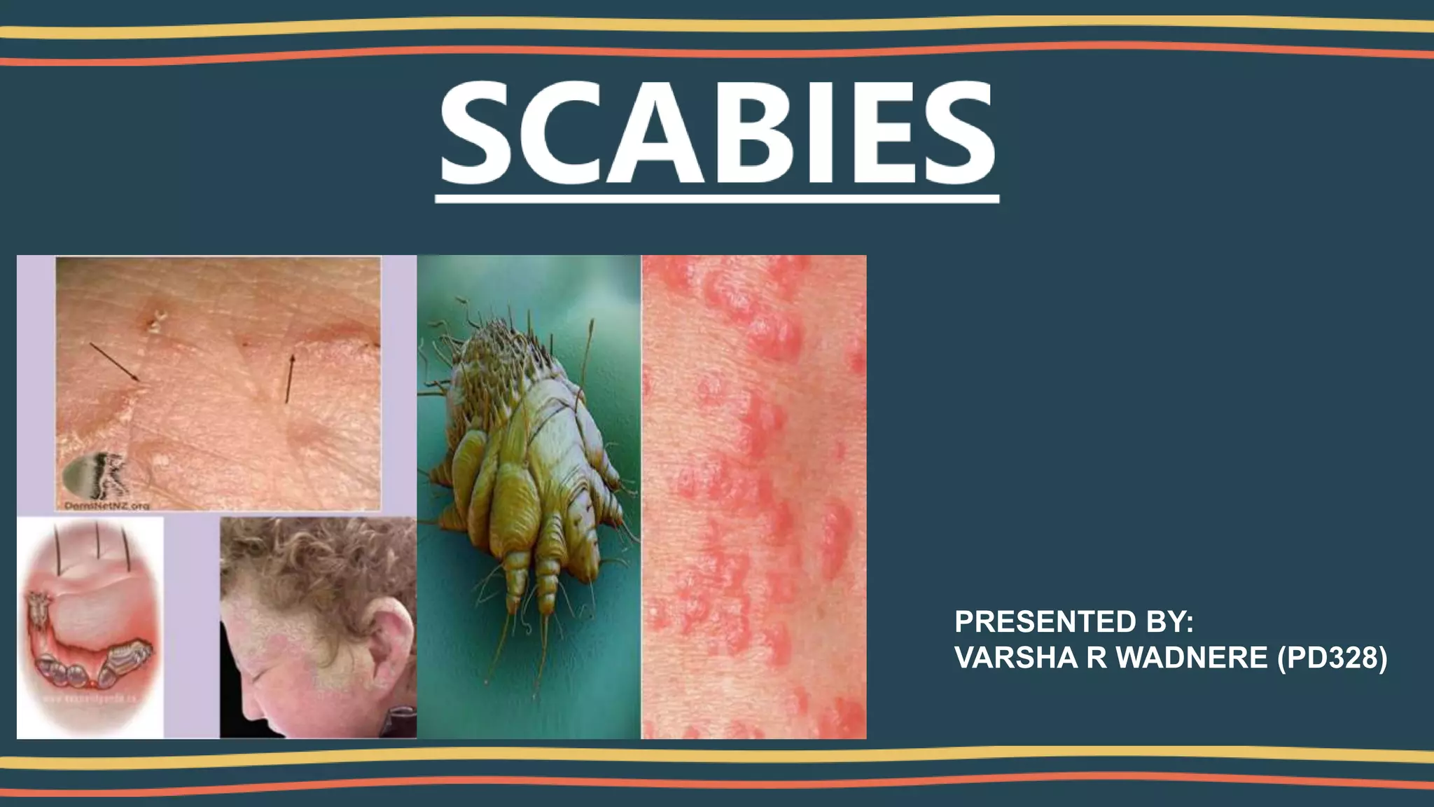 SCABIES CASE PRESENTATION | PPTX