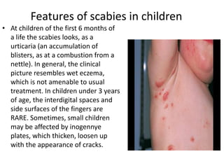 SCABIES | PPTX