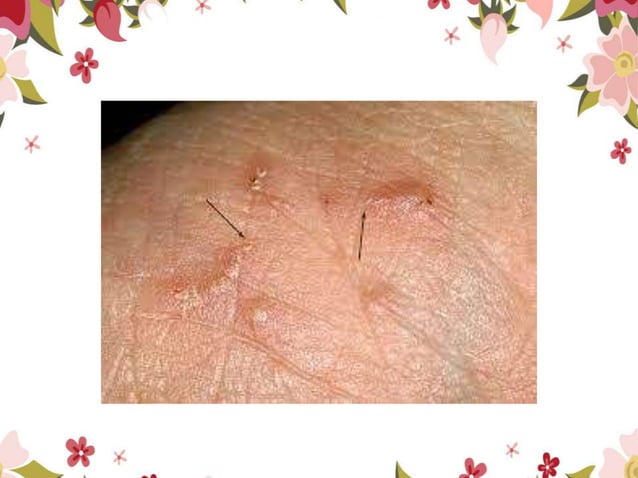scabies.pptx | Skin and Dermatology | Diseases and Conditions