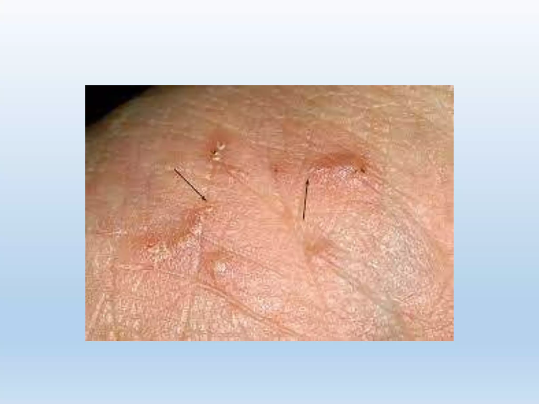 Scabies for MBBS students | PPTX