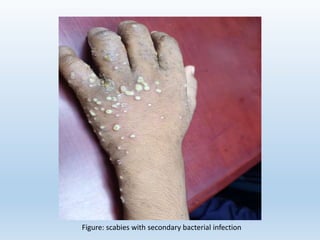 Scabies for MBBS students | PPTX
