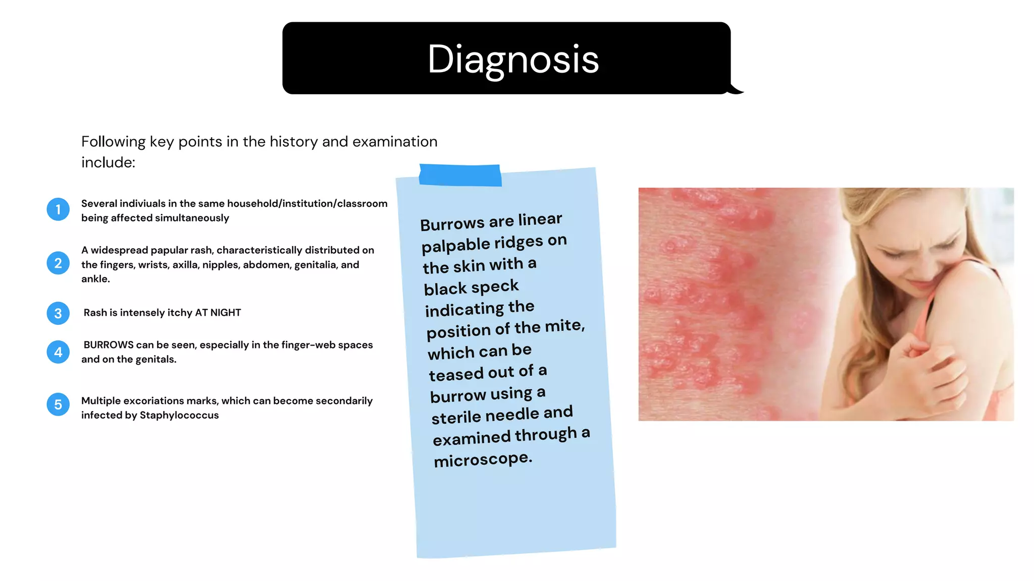 Scabies | PPT