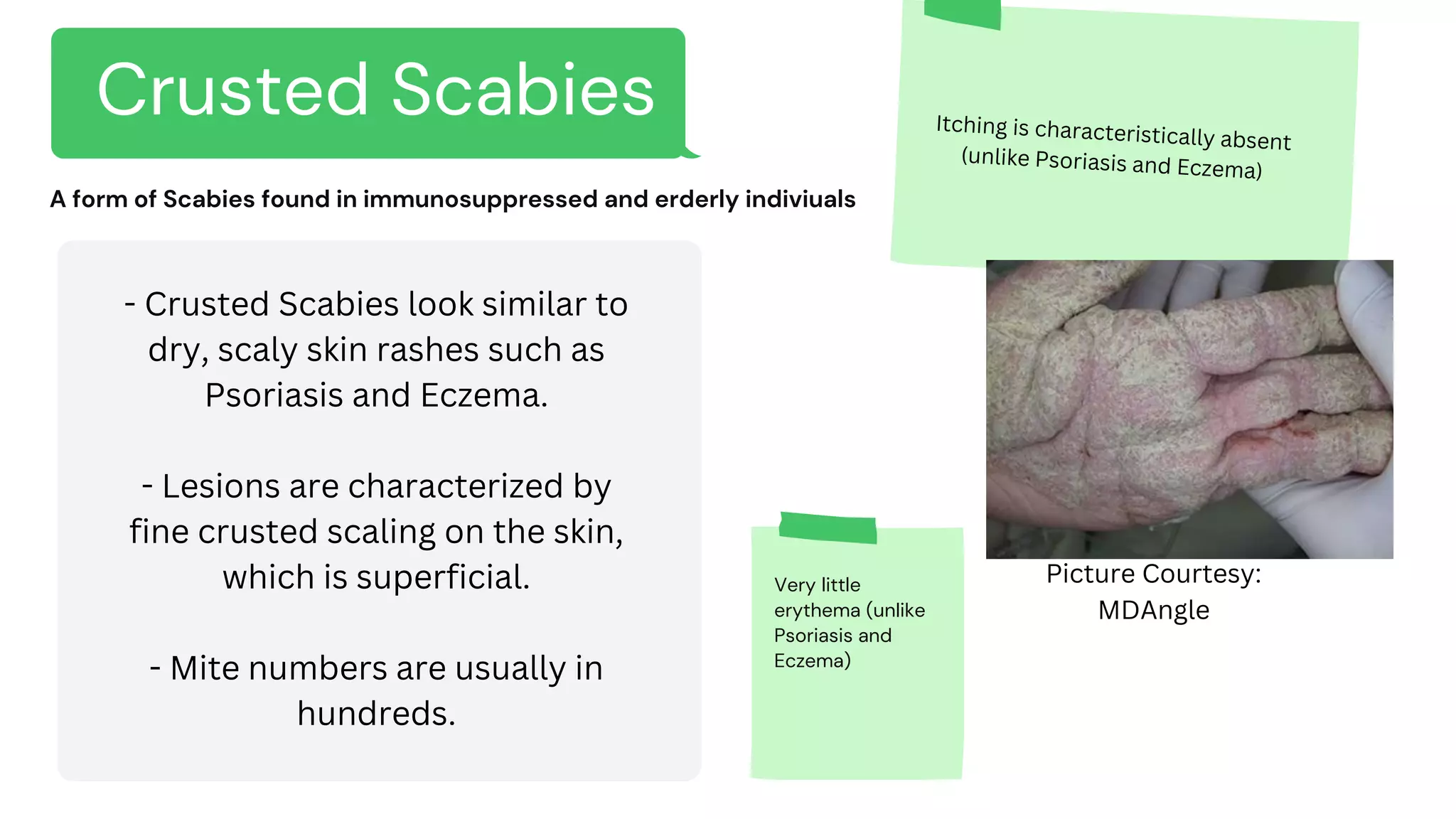 Scabies | PPT
