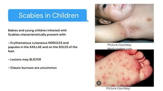 Scabies | PPT