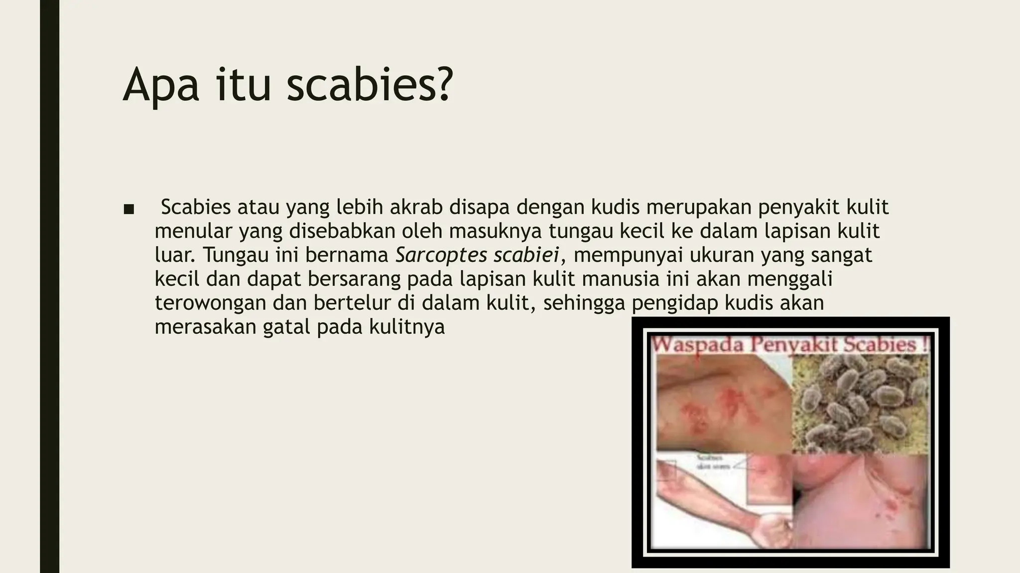 scabies.pptx