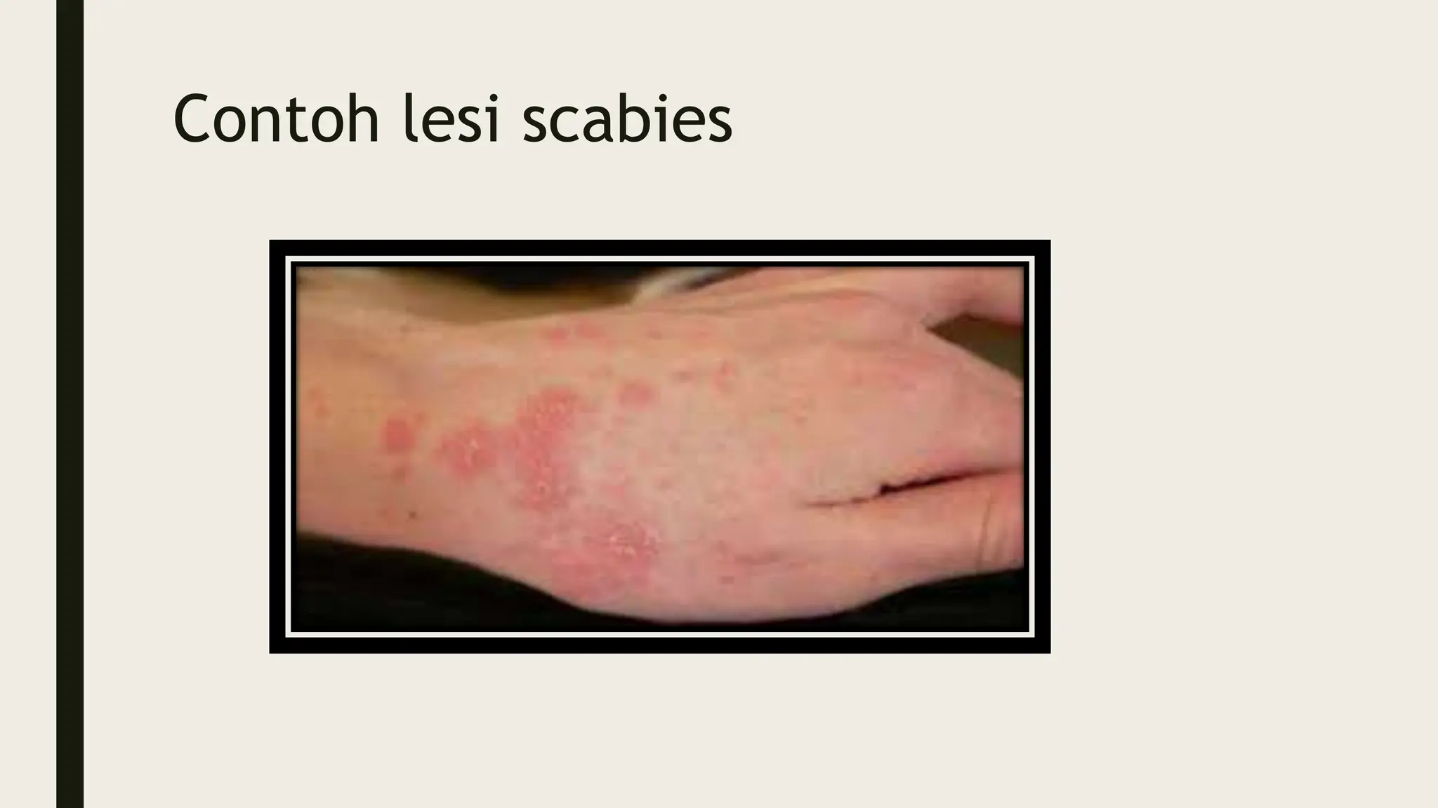 scabies.pptx