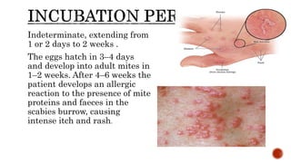 scabies.pptx
