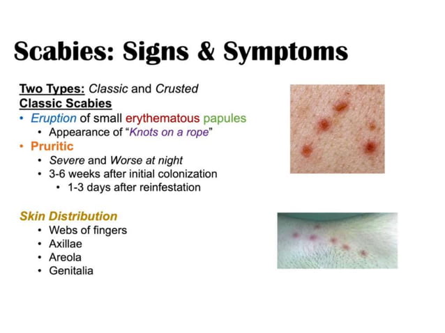 Clinical Pharmacotherapy of Scabies Disease | PPTX