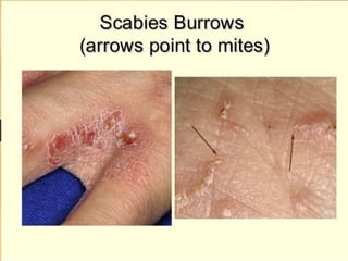 Scabies.pptx. by Azizullah Aziz Abdali af | PPT | Free Download