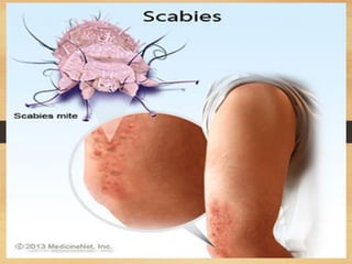 Scabies.pptx. by Azizullah Aziz Abdali af | PPT