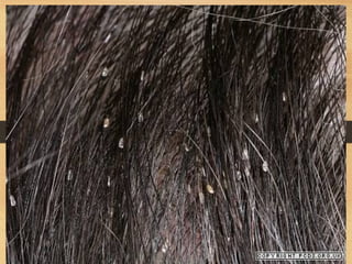 Scabies.pptx. by Azizullah Aziz Abdali af | PPT