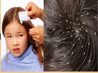 Scabies.pptx. by Azizullah Aziz Abdali af | PPT