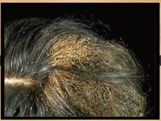 Scabies.pptx. by Azizullah Aziz Abdali af | PPT