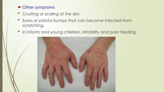 SCABIES as skin disease in adults and children | PPTX