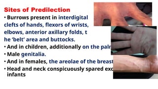 Dermatology presentation on scabies it's manifestation and management ...