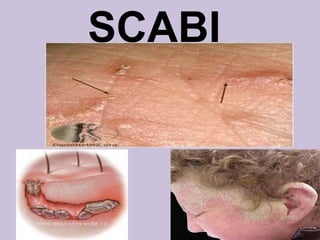 scabies-PRANAV KOHLI.pptx