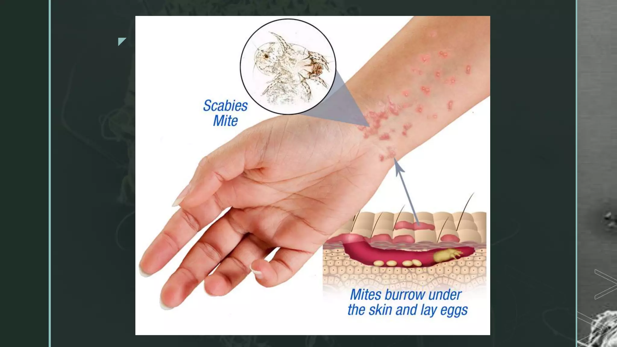 Scabies | PPTX